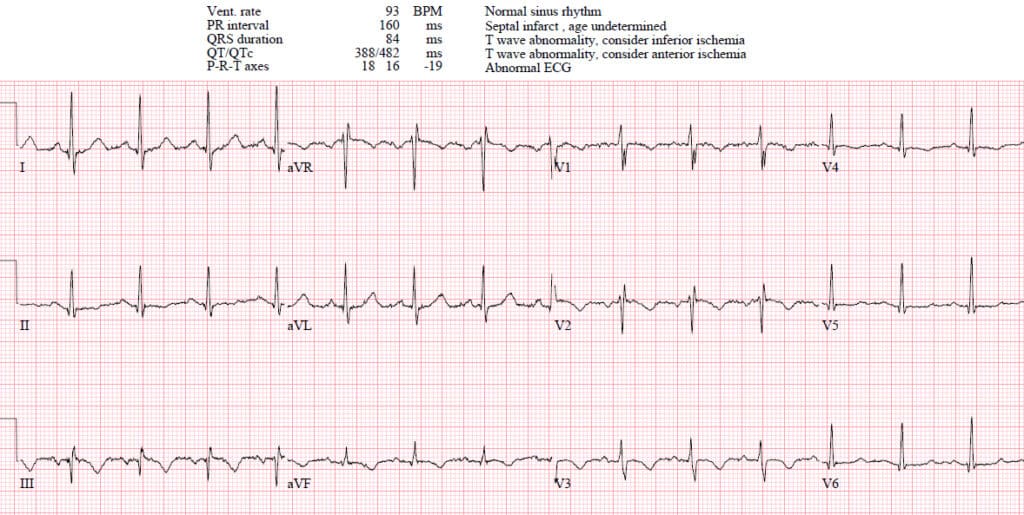 ECG Cases 15: Tall R Wave in V1 | Emergency Medicine Cases