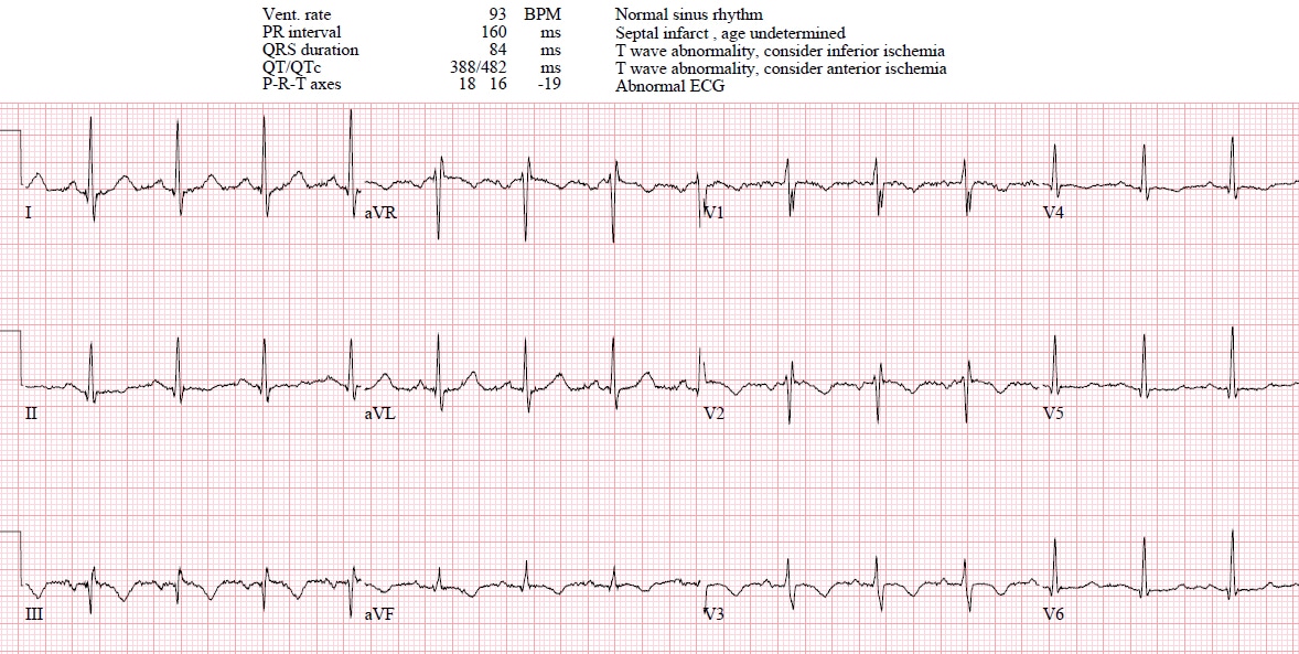 ECG Cases 15: Tall R Wave in V1 | Emergency Medicine Cases