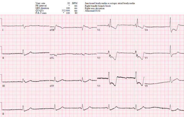 ECG Cases 15: Tall R Wave in V1 | Emergency Medicine Cases
