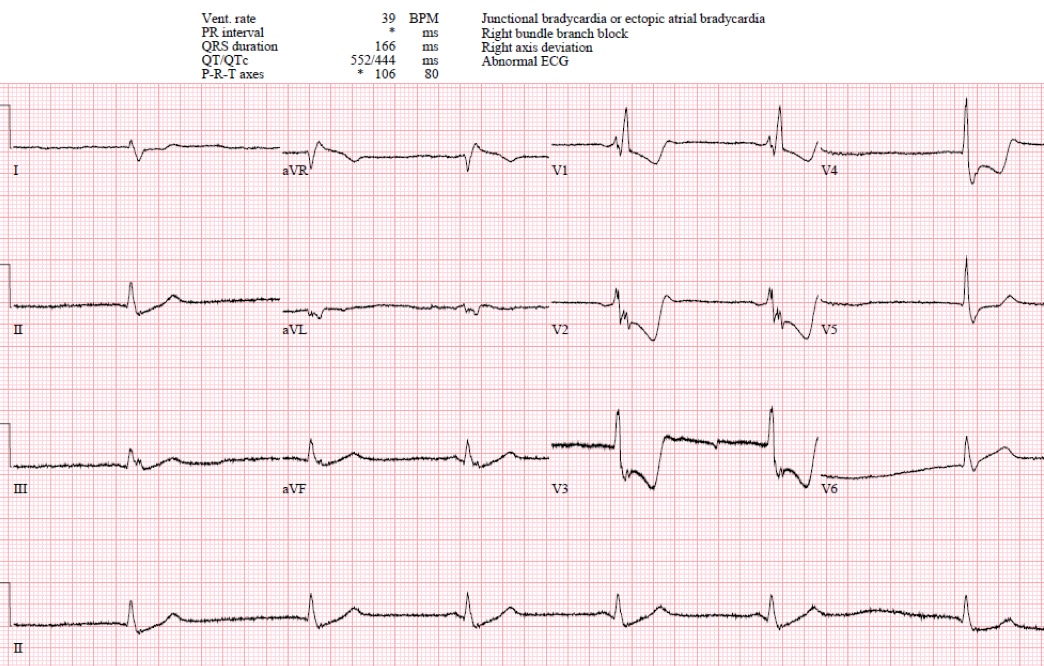 ECG Cases 15: Tall R Wave in V1 | Emergency Medicine Cases