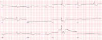 ECG Cases 15: Tall R Wave in V1 | Emergency Medicine Cases