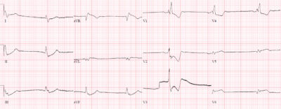 ECG Cases 15: Tall R Wave in V1 | Emergency Medicine Cases