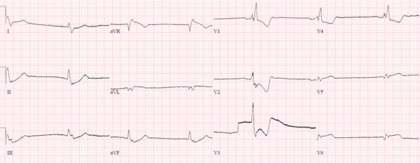 ECG Cases 15: Tall R Wave in V1 | Emergency Medicine Cases