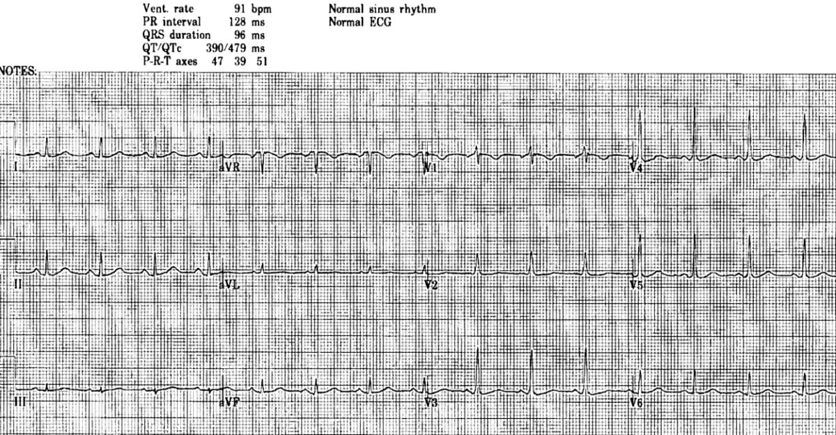 ECG Cases 15: Tall R Wave in V1 | Emergency Medicine Cases