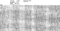 ECG Cases 15: Tall R Wave in V1 | Emergency Medicine Cases