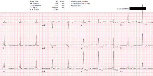 ECG Cases 15: Tall R Wave in V1 | Emergency Medicine Cases