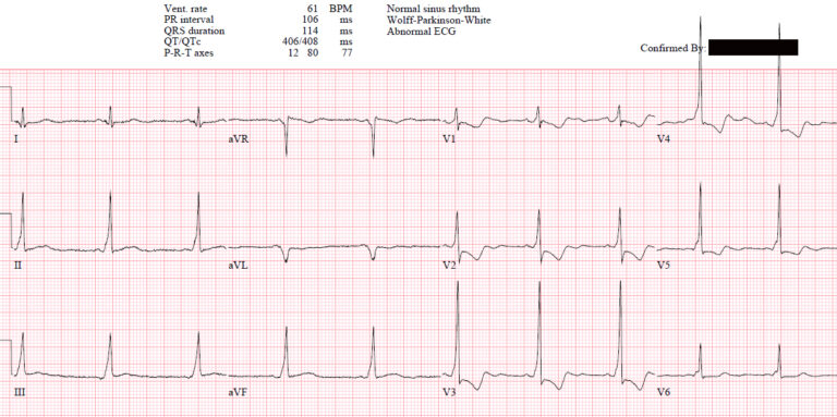 ECG Cases 15: Tall R Wave in V1 | Emergency Medicine Cases