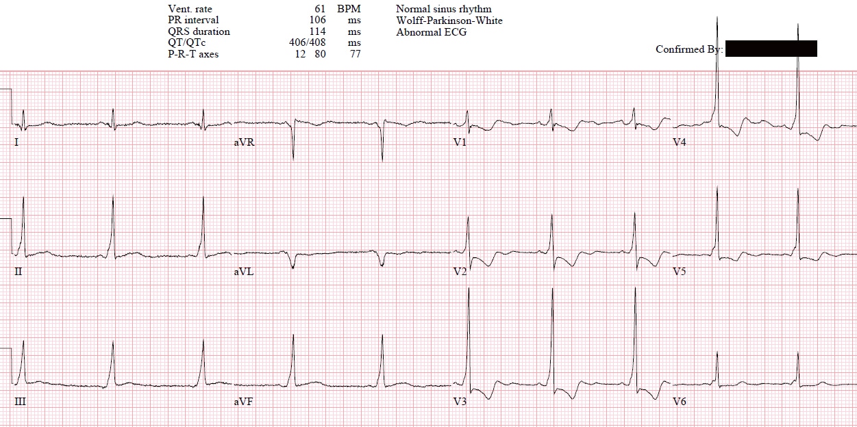 ECG Cases 15: Tall R Wave in V1 | Emergency Medicine Cases