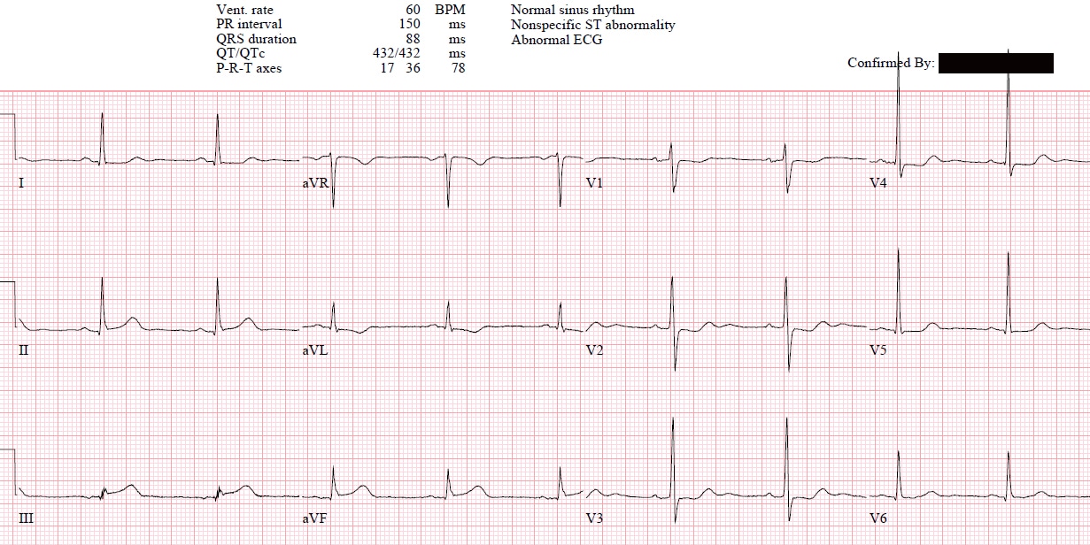 ECG Cases 15: Tall R Wave in V1 | Emergency Medicine Cases