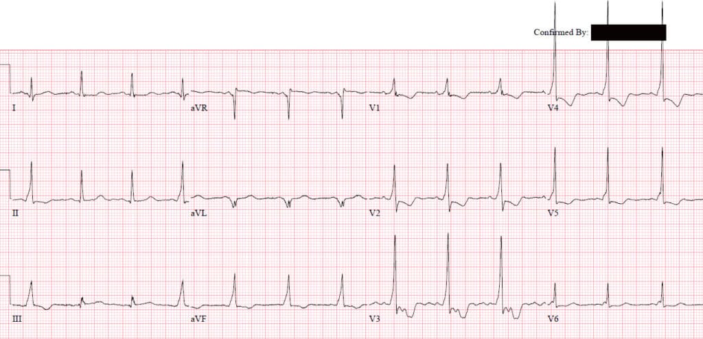 ECG Cases 15: Tall R Wave in V1 | Emergency Medicine Cases