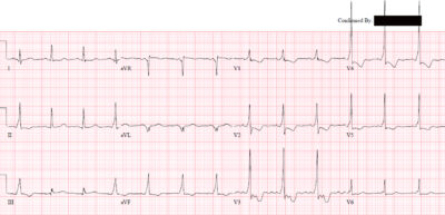 ECG Cases 15: Tall R Wave in V1 | Emergency Medicine Cases