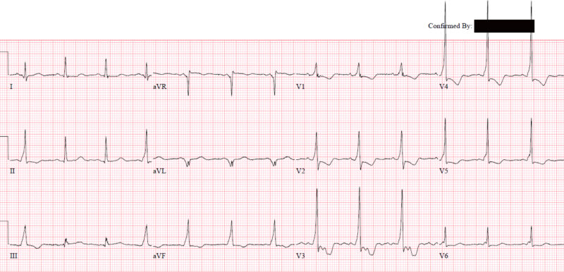 ECG Cases 15: Tall R Wave in V1 | Emergency Medicine Cases