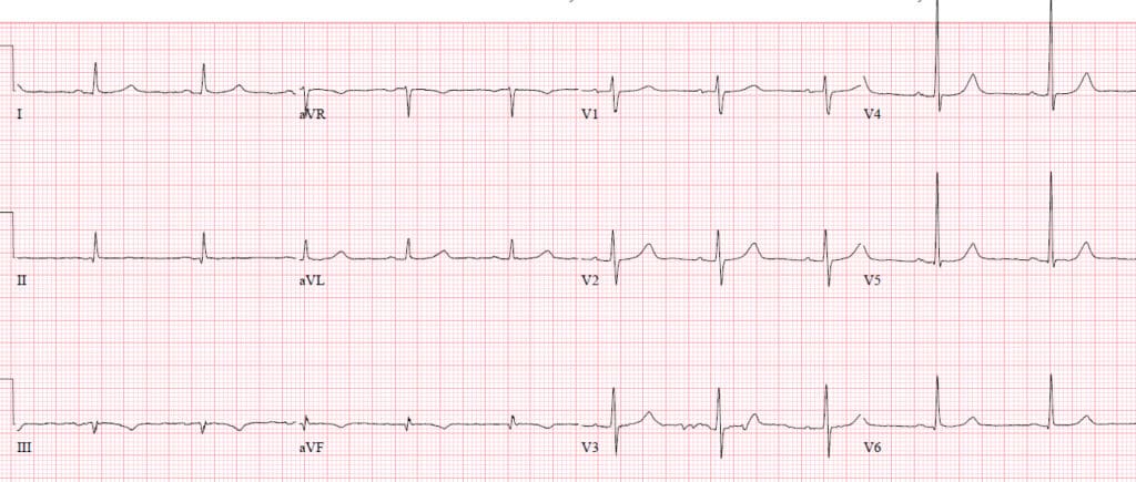 ECG Cases 15: Tall R Wave in V1 | Emergency Medicine Cases