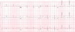 ECG Cases 15: Tall R Wave in V1 | Emergency Medicine Cases
