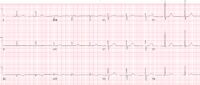 ECG Cases 15: Tall R Wave in V1 | Emergency Medicine Cases
