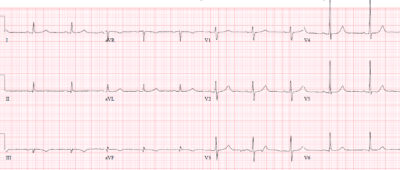 ECG Cases 15: Tall R Wave in V1 | Emergency Medicine Cases