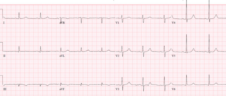 ECG Cases 15: Tall R Wave in V1 | Emergency Medicine Cases
