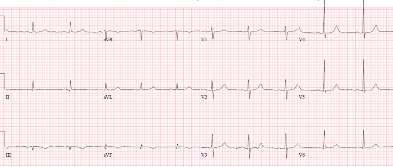 ECG Cases 15: Tall R Wave in V1 | Emergency Medicine Cases