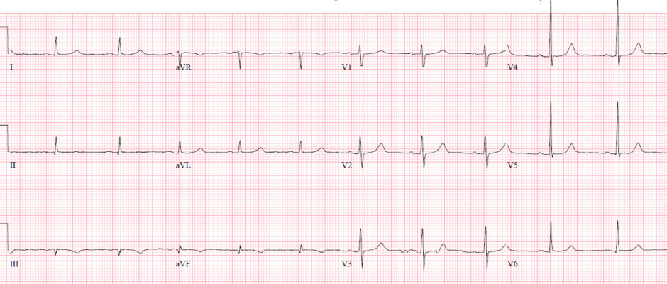 ECG Cases 15: Tall R Wave in V1 | Emergency Medicine Cases