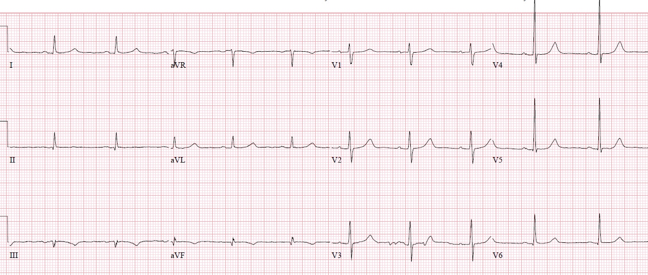 ECG Cases 15: Tall R Wave in V1 | Emergency Medicine Cases