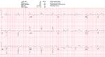 ECG Cases 15: Tall R Wave in V1 | Emergency Medicine Cases