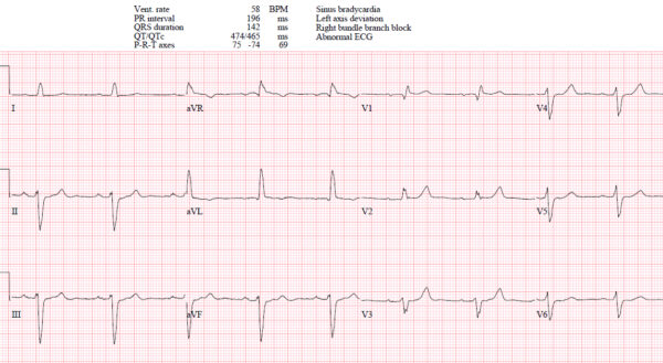ECG Cases 15: Tall R Wave in V1 | Emergency Medicine Cases