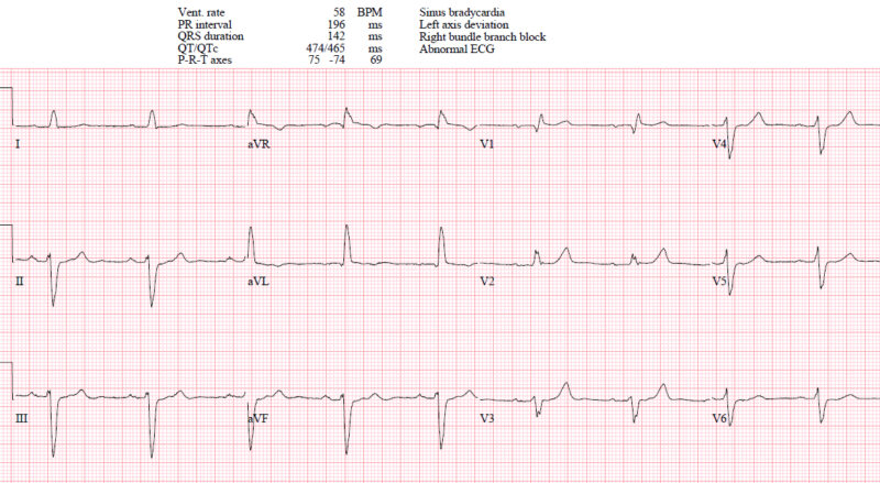 ECG Cases 15: Tall R Wave in V1 | Emergency Medicine Cases