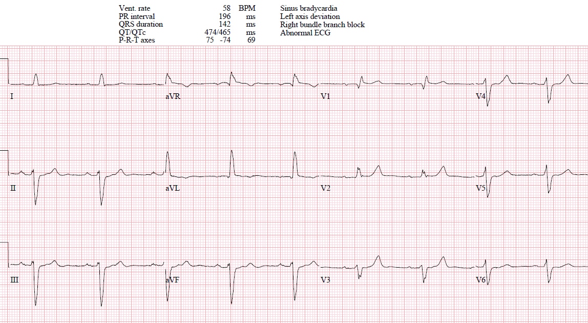 ECG Cases 15: Tall R Wave in V1 | Emergency Medicine Cases