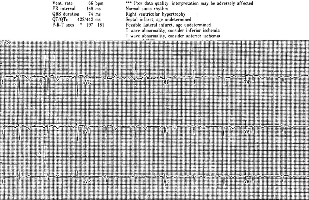 ECG Cases 15: Tall R Wave in V1 | Emergency Medicine Cases