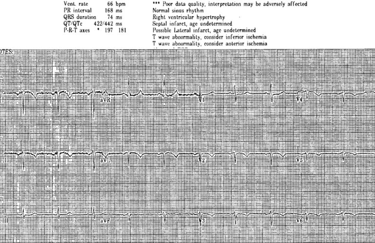 ECG Cases 15: Tall R Wave in V1 | Emergency Medicine Cases