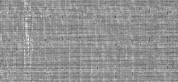 ECG Cases 15: Tall R Wave in V1 | Emergency Medicine Cases