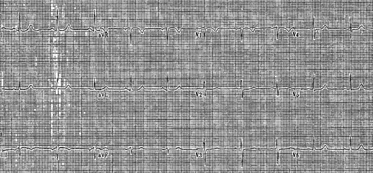 ECG Cases 15: Tall R Wave in V1 | Emergency Medicine Cases