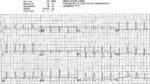 ECG Cases 15: Tall R Wave in V1 | Emergency Medicine Cases