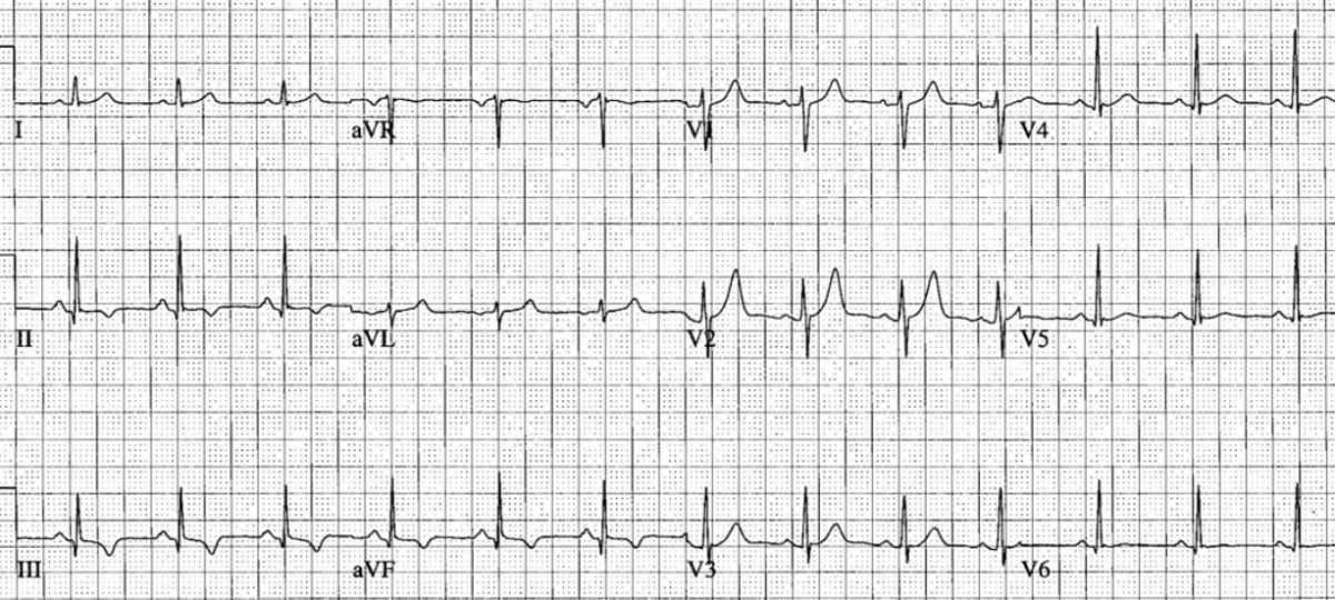 ECG Cases 15: Tall R Wave in V1 | Emergency Medicine Cases