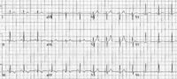 ECG Cases 15: Tall R Wave in V1 | Emergency Medicine Cases