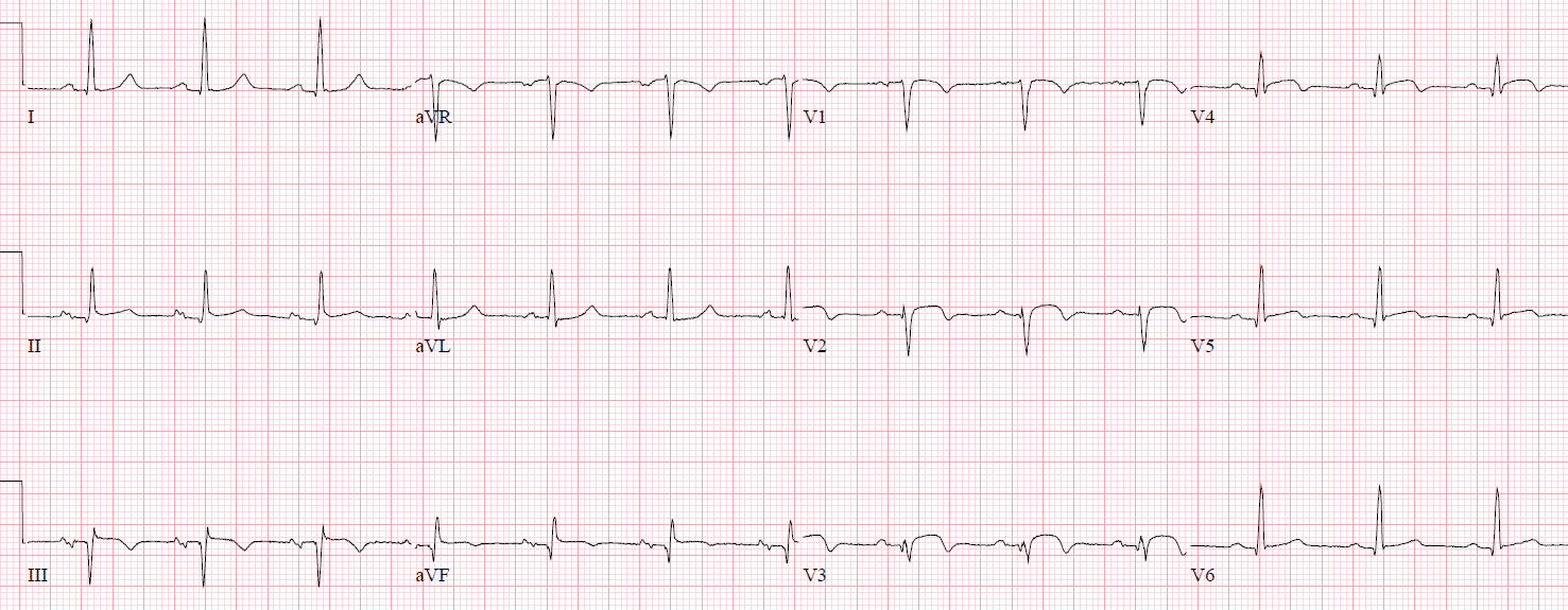 ST ELEVATION Mneumonic and Occlusion MI | ECG Cases | EM Cases