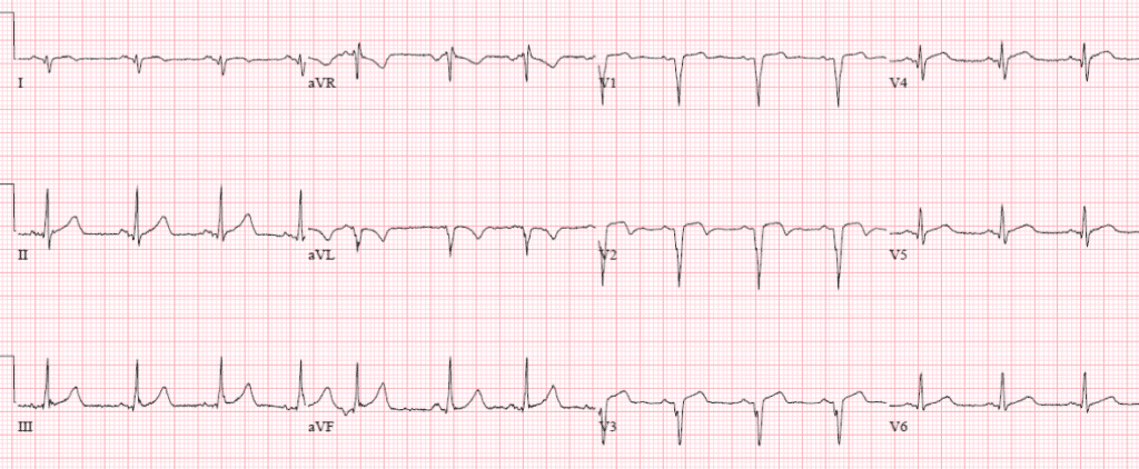 ST ELEVATION Mneumonic and Occlusion MI | ECG Cases | EM Cases