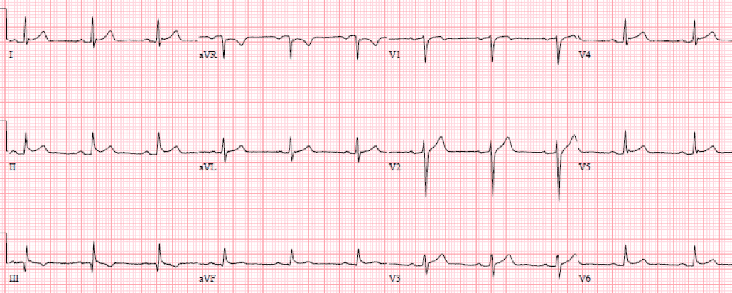 ST ELEVATION Mneumonic and Occlusion MI | ECG Cases | EM Cases