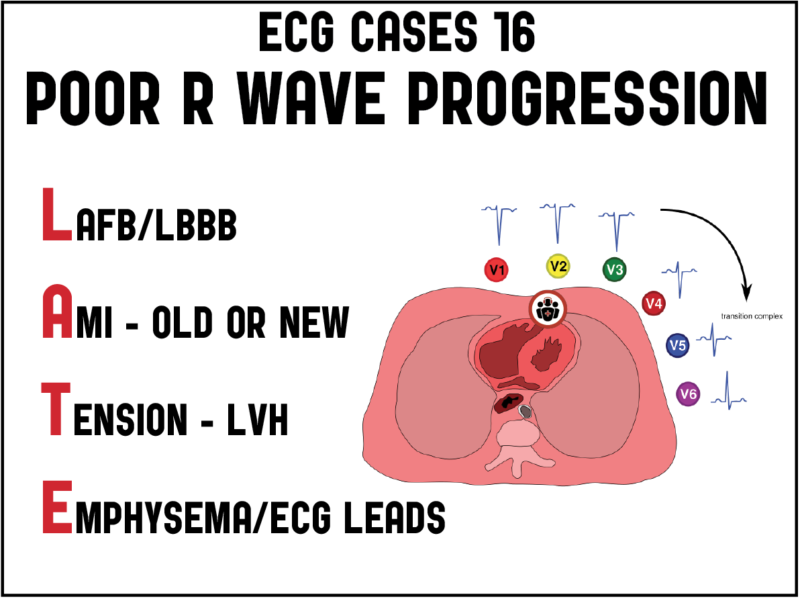 ECG Cases 16 Poor R wave Progression LATE Mnemonic ECG Cases