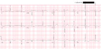 ECG Cases 16: poor R-wave progression - LATE mnemonic | ECG Cases