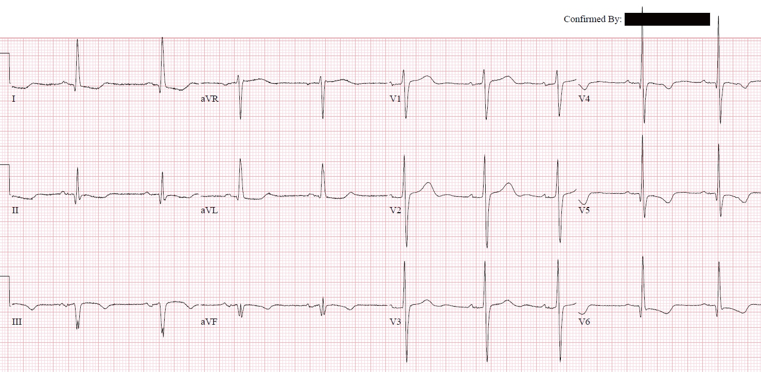 ECG Cases 16: poor R-wave progression - LATE mnemonic | ECG Cases