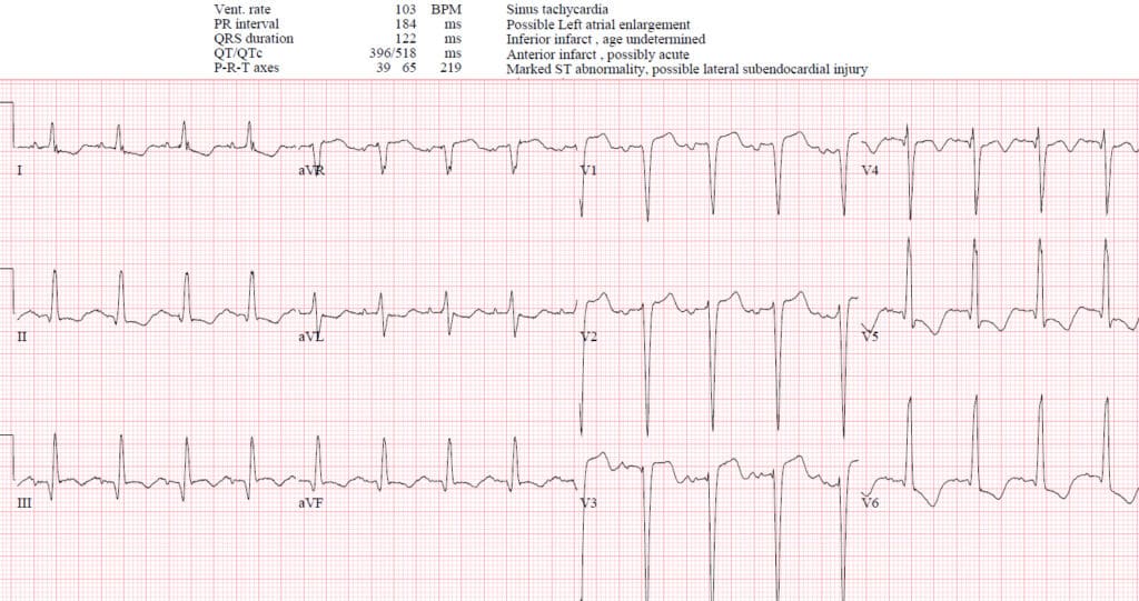 ECG Cases 16: poor R-wave progression - LATE mnemonic | ECG Cases