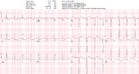 ECG Cases 16: poor R-wave progression - LATE mnemonic | ECG Cases