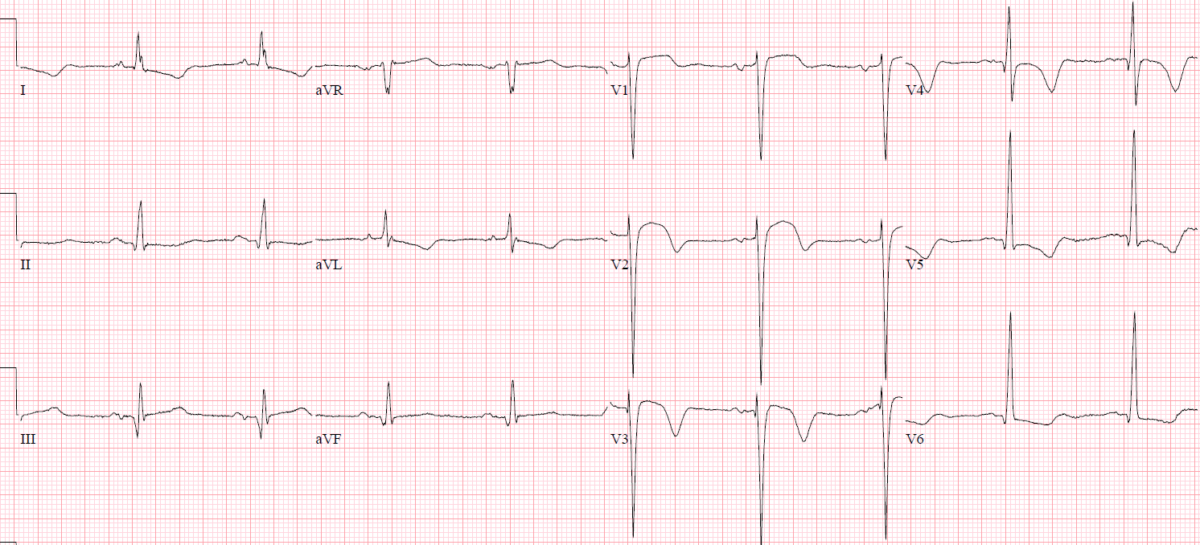 ECG Cases 16: poor R-wave progression - LATE mnemonic | ECG Cases