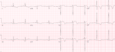 ECG Cases 16: poor R-wave progression - LATE mnemonic | ECG Cases