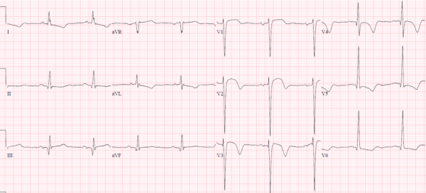 ECG Cases 16: poor R-wave progression - LATE mnemonic | ECG Cases