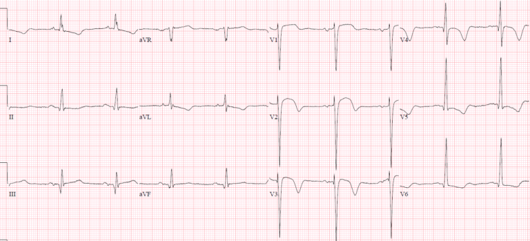 ECG Cases 16: poor R-wave progression - LATE mnemonic | ECG Cases