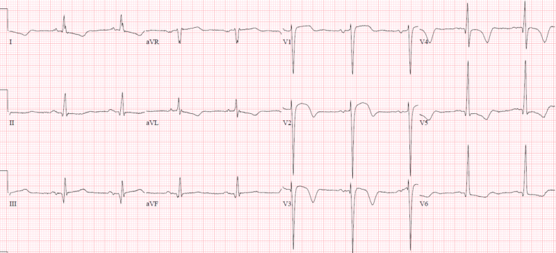 ECG Cases 16: poor R-wave progression - LATE mnemonic | ECG Cases