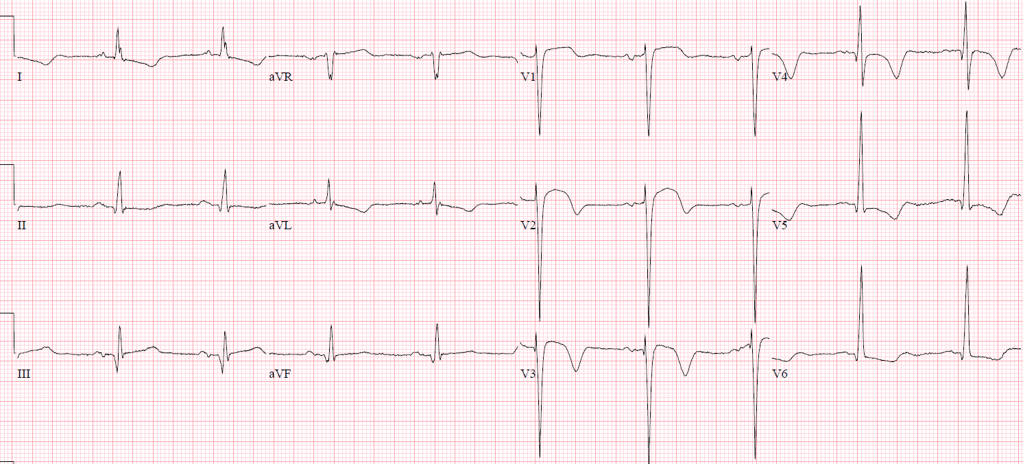 ECG Cases 16: poor R-wave progression - LATE mnemonic | ECG Cases