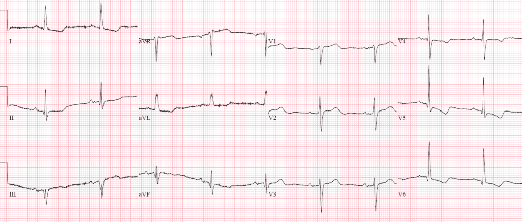 ECG Cases 16: poor R-wave progression - LATE mnemonic | ECG Cases